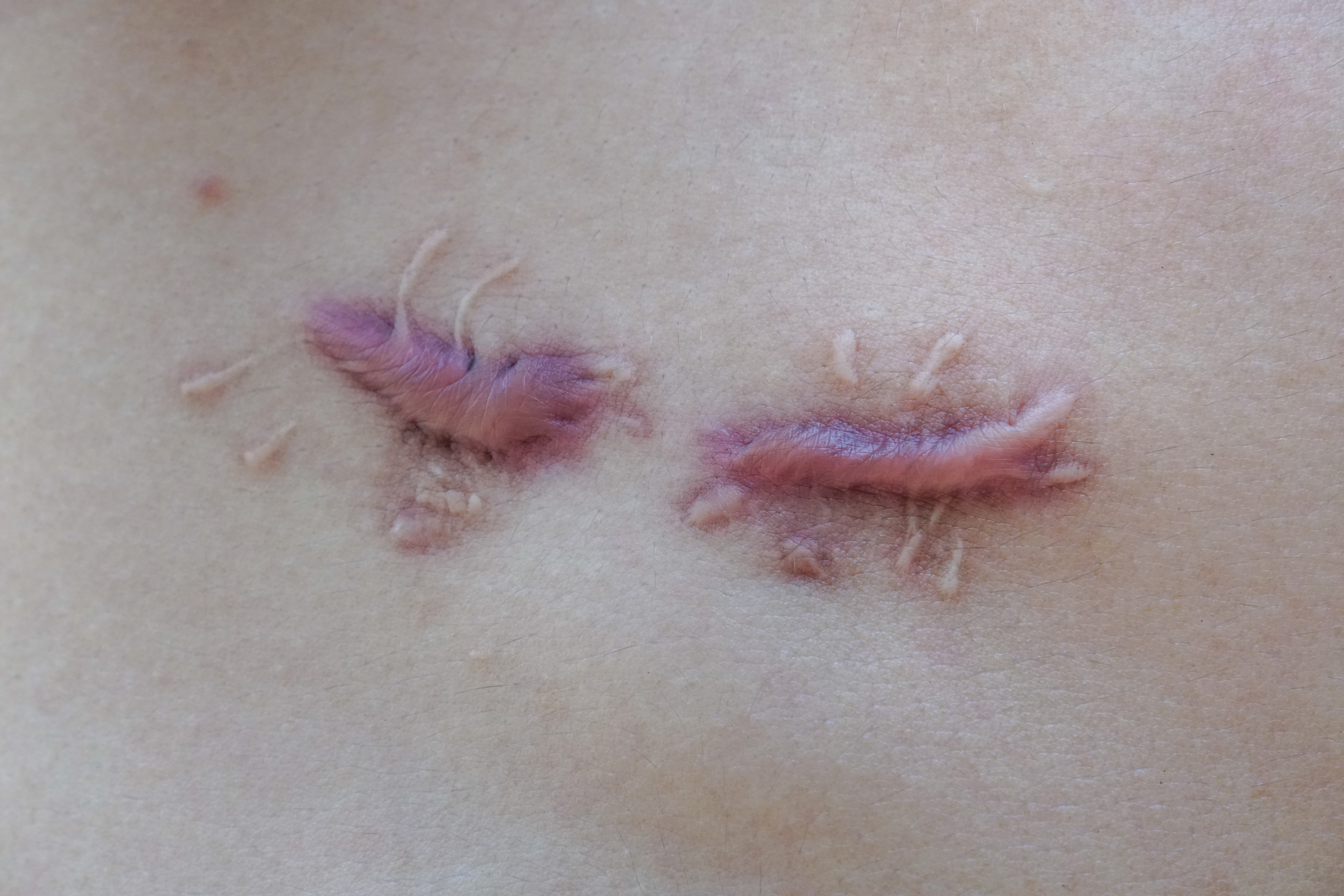 Keloid Scars | Princ Hospital Lamphun