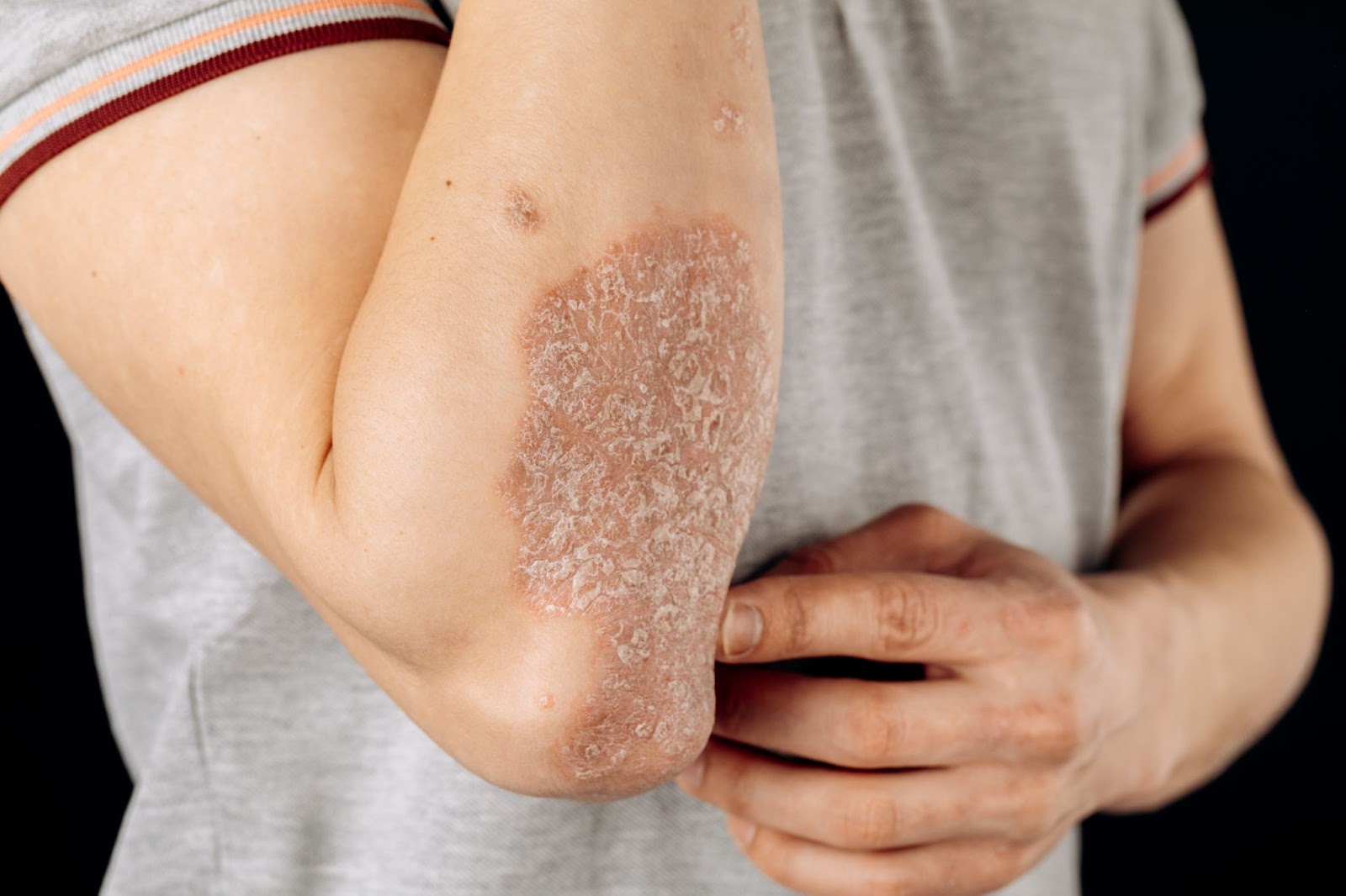 สะเก็ดเงิน เป็นแล้วรักษาอย่างไร?