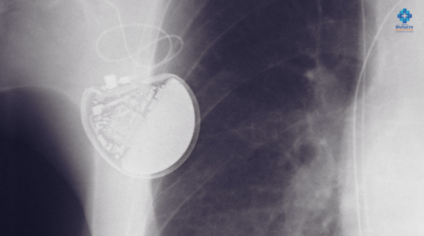 เครื่องกระตุ้นไฟฟ้าหัวใจ (Permanent Pacemaker) ตัวช่วยรักษาหัวใจ ...